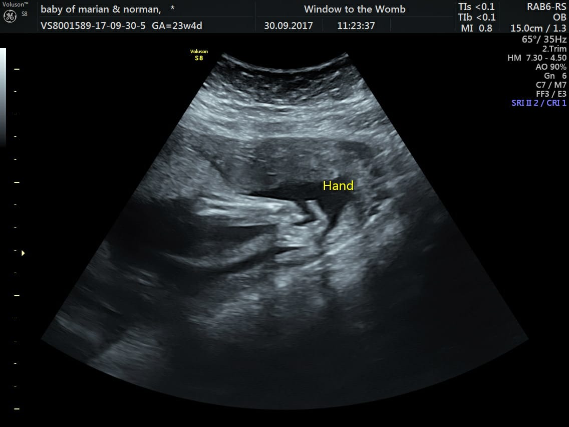 Amazing Story of Baby Jack; Born With One Hand | Window to the Womb ...
